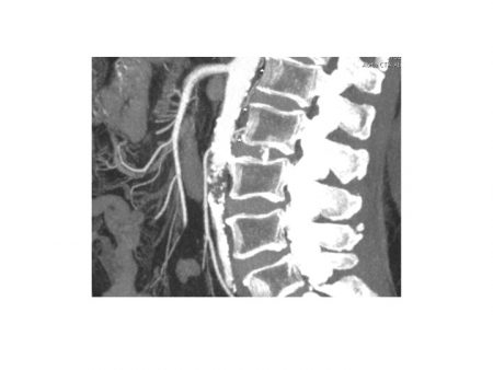 CAUSAS RARA DE ISQUEMIA – Imagen Vascular